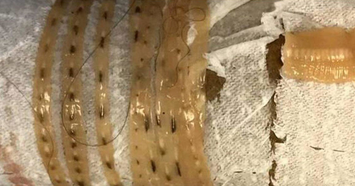 Five Foot Long Tapeworm Came ‘Wiggling Out’ Of Man’s Body After Eating ...